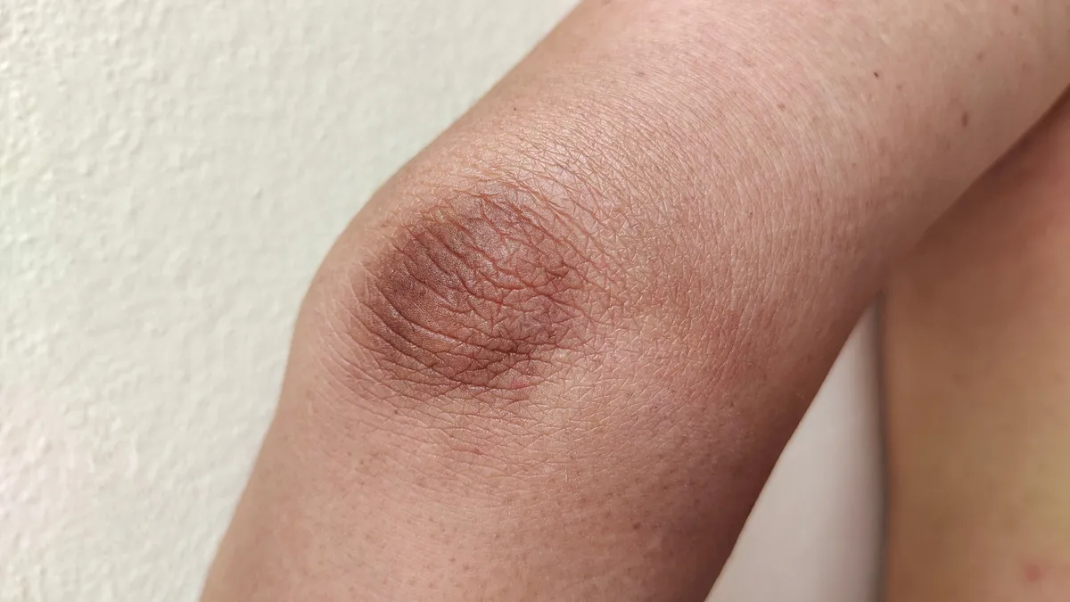 La piel de tus codos oscura revela esto sobre tu salud hormonal – Pixel Más